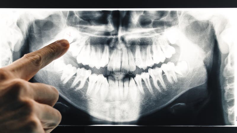 Dentist Hand Points To Teeth in X-ray Stock Image - Image of xray ...