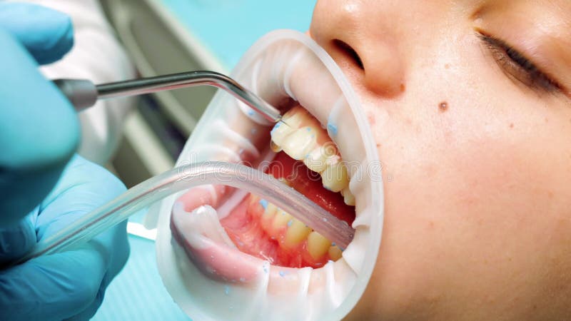 Close-up of Dental Suction and Plaque Removal during Teeth Cleaning ...