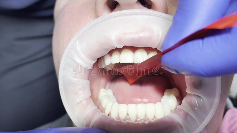 Dentistry. Checking Jaw Occlusion Using Articulating Paper Stock ...
