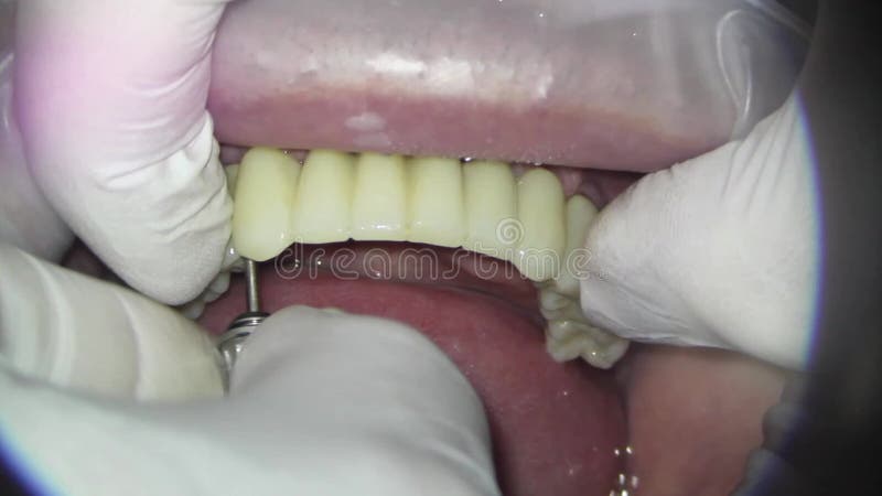 Dentistry. Shooting with a Microscope Stock Footage - Video of ...