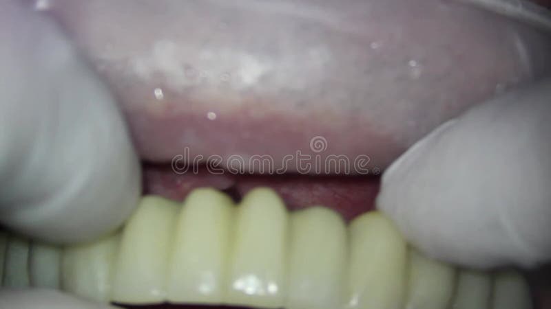 Dentistry. Shooting with a Microscope Stock Video - Video of equipment ...