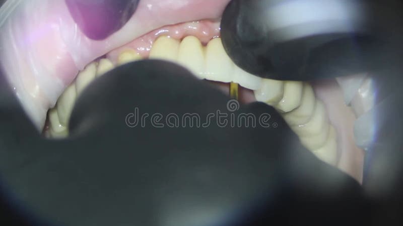 Dentistry. Shooting with a Microscope Stock Video - Video of hygienist ...