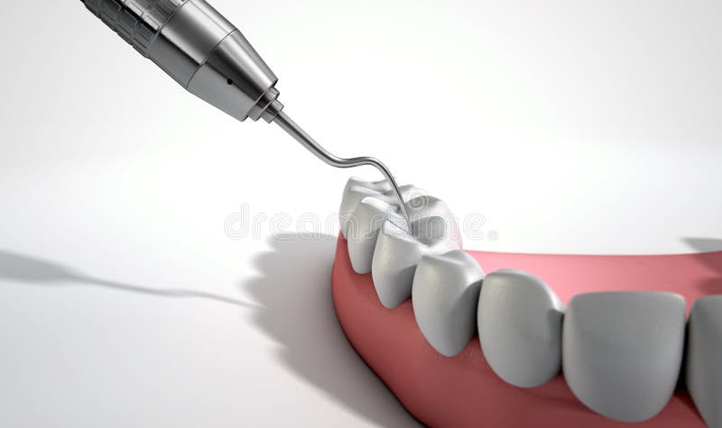 Dentists Probe Hook and Teeth Stock Illustration - Illustration of ...
