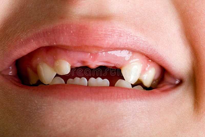 Dents Manquantes De Bouche D'enfant Image stock - Image du enfant ...