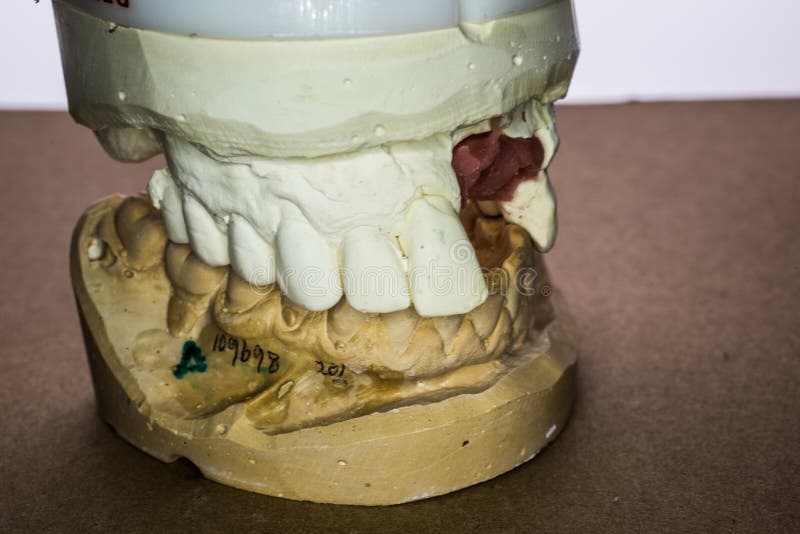 Denture Impression Made of Plaster with Implants Stock Image - Image of ...
