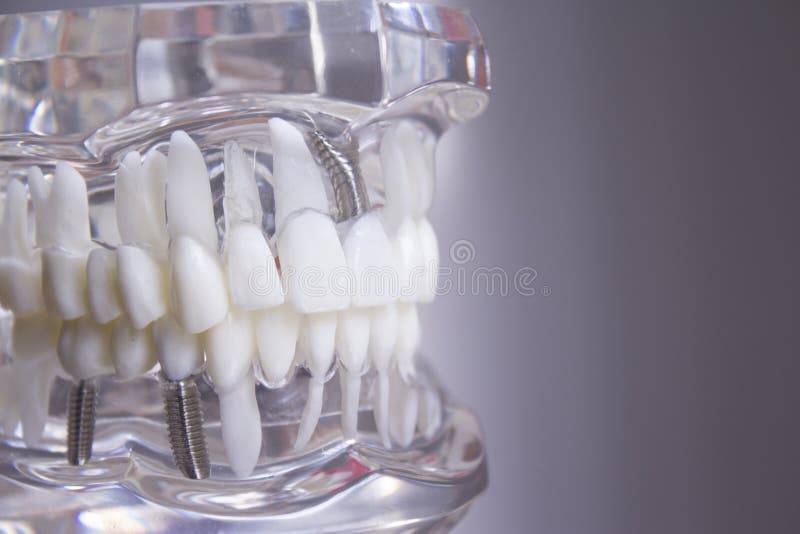 Denture for Students Transparent Stock Photo - Image of tooth ...