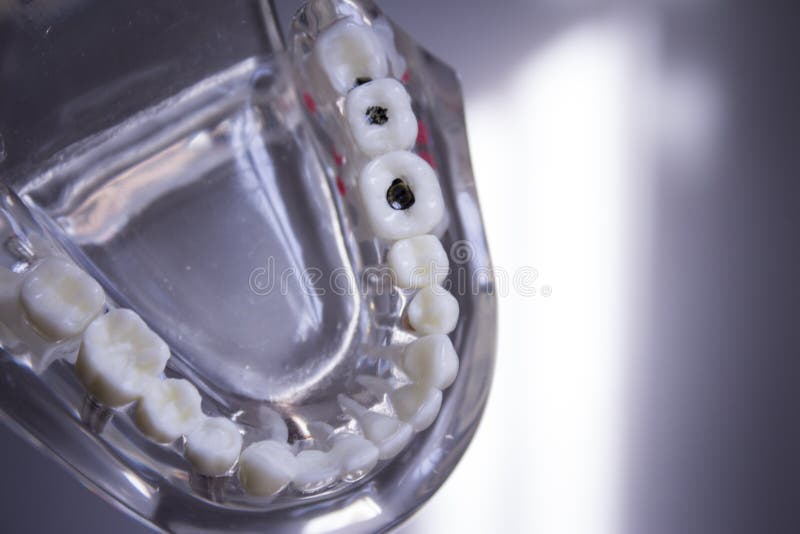 Denture for Students Transparent Stock Photo - Image of clean ...