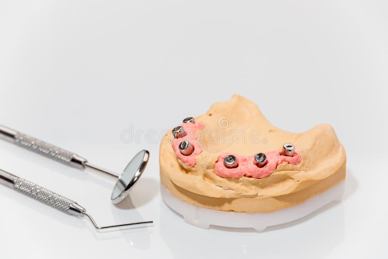 Dentures, Dental Prosthesis, Model Stock Photo - Image of prosthesis ...