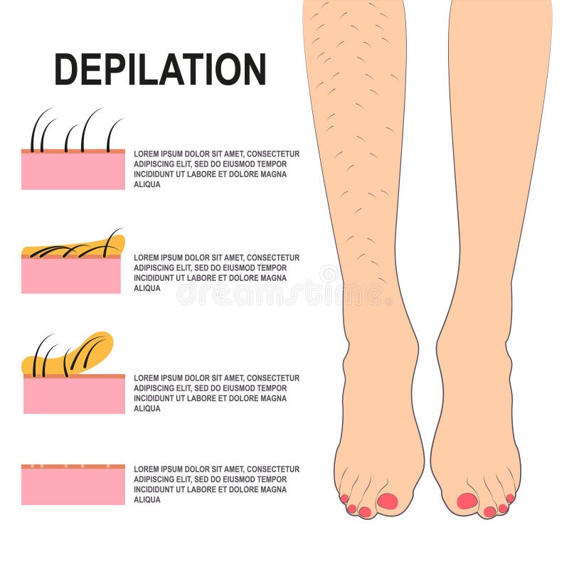 Depilation Vector Illustration Stock Vector - Illustration of removal ...