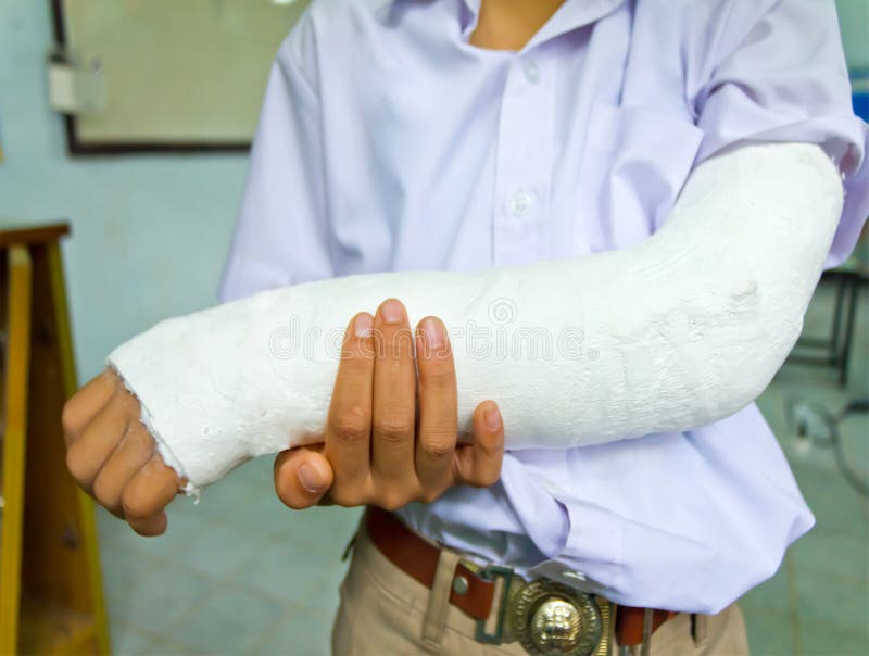 Der Arm Des Studenten Ist Gebrochen Stockfoto - Bild von krankenhaus ...