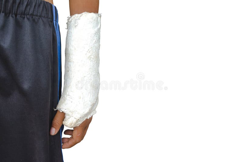 Der Gebrochene Arm Des Jungen in Der Form Stockbild - Bild von ...