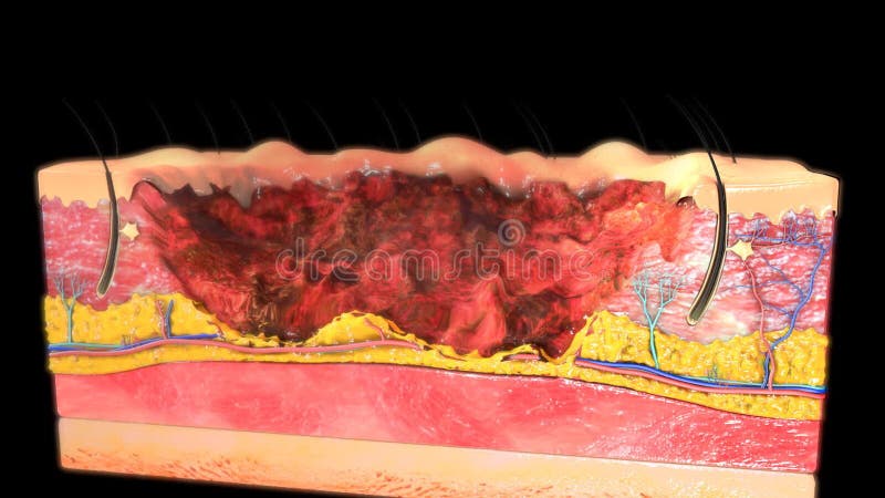 Een Derdegraads Brandwond Zal Alle Lagen Van De Huid Beschadigen : De ...