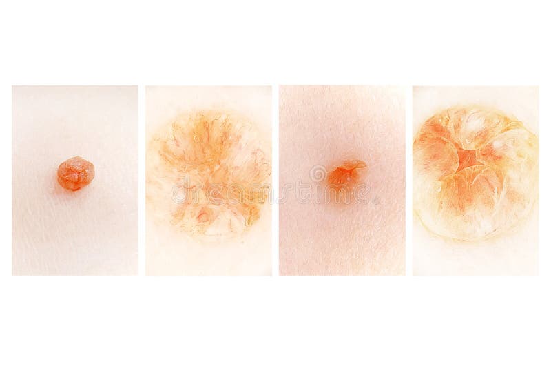 Dermal Nevus of the Skin. Dermatoscopic Picture. Dermatological Set ...