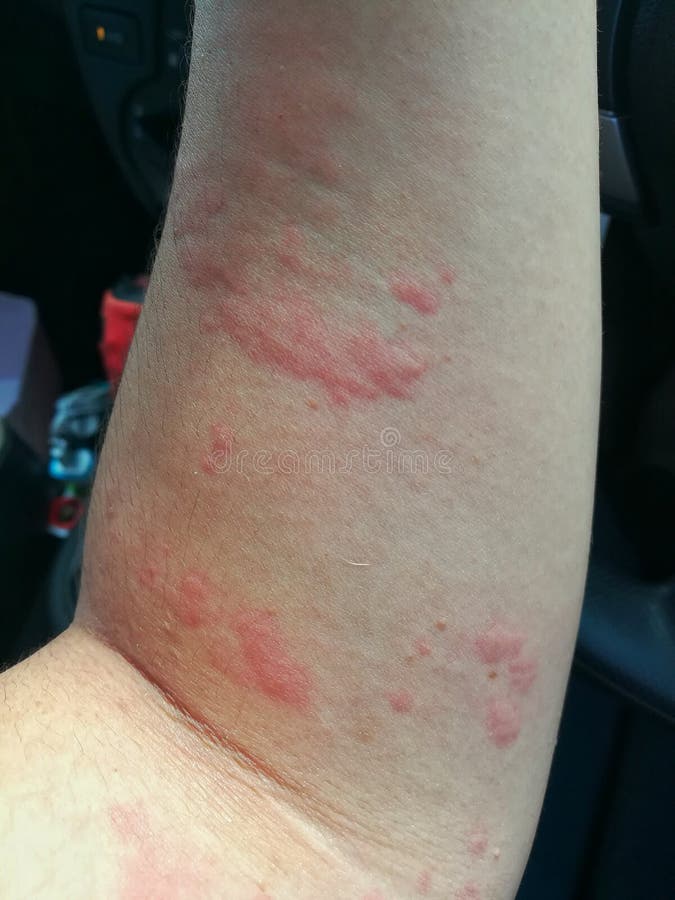 Dermatite Allergique De Dermatite D'éruption Cutanée Allergique ...