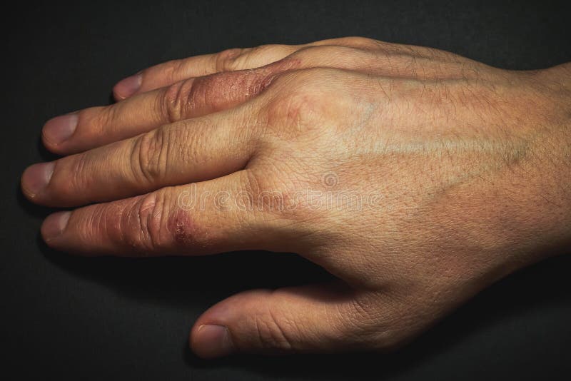 Dermatite De Main Eczema De Main Photo stock - Image du allergique ...