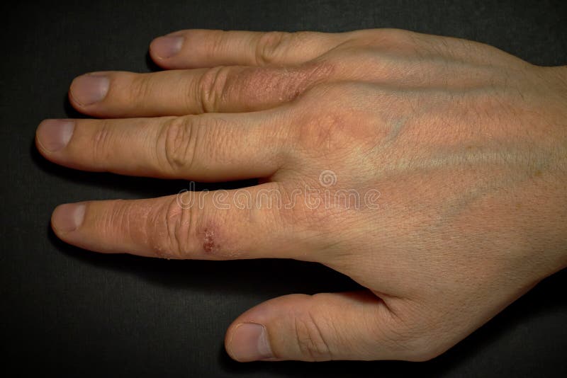 Dermatite De Main Eczema De Main Image stock - Image du allergie ...