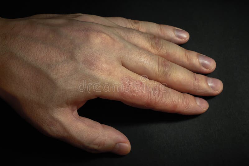 Dermatite De Main Eczema De Main Photo stock - Image du allergique ...