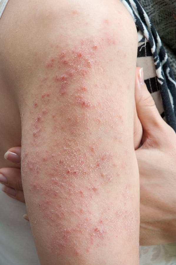 Peau Impétueuse Allergique D'eczema De Dermatite Des Jambes Patientes ...