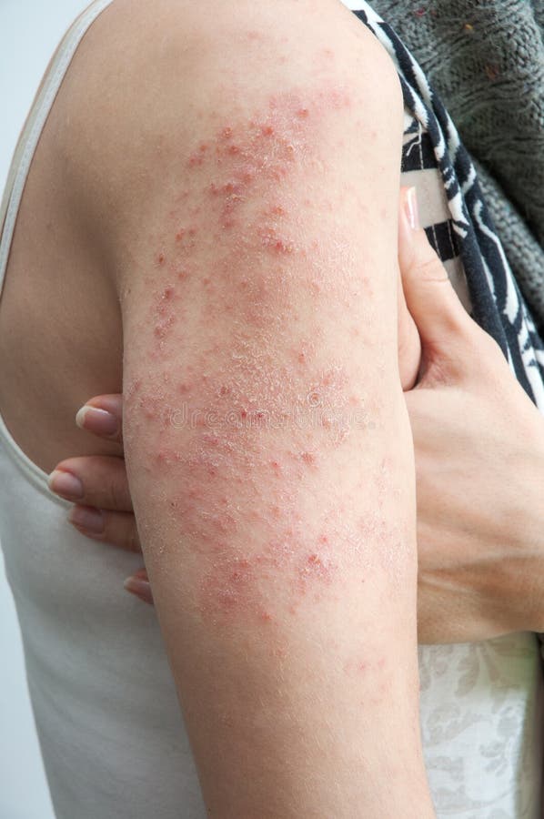 Pelle Impetuosa Allergica Della Dermatite Immagine Stock - Immagine di ...