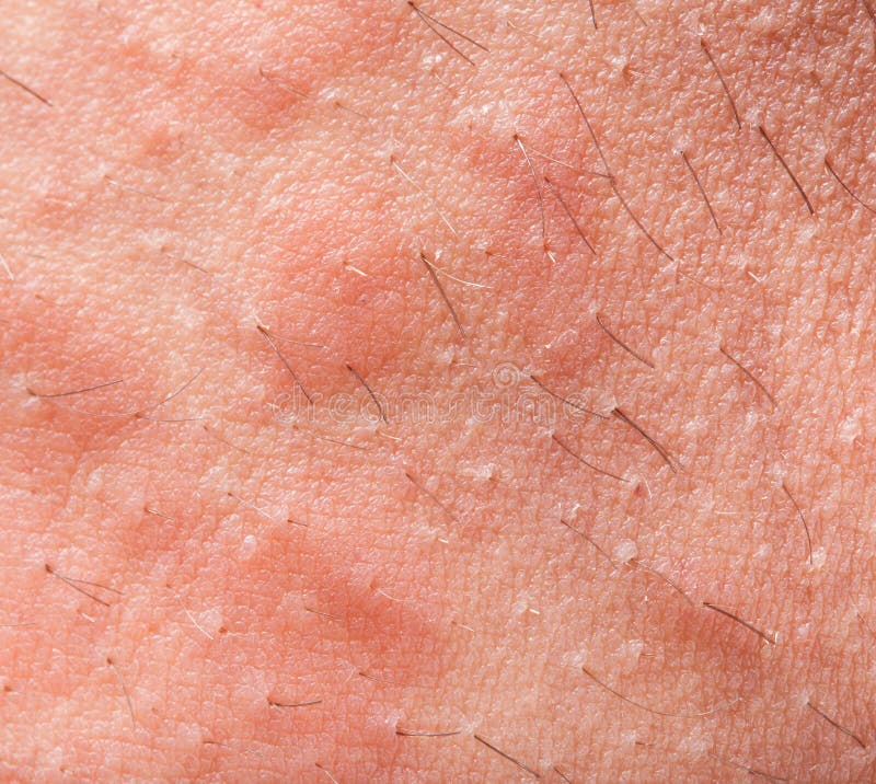 Dermatitis Atópico Del Eczema Imagen de archivo - Imagen de célula ...