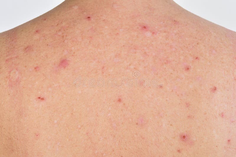 Dermatitis on the Back of a Stock Image - Image of healthcare, rash ...