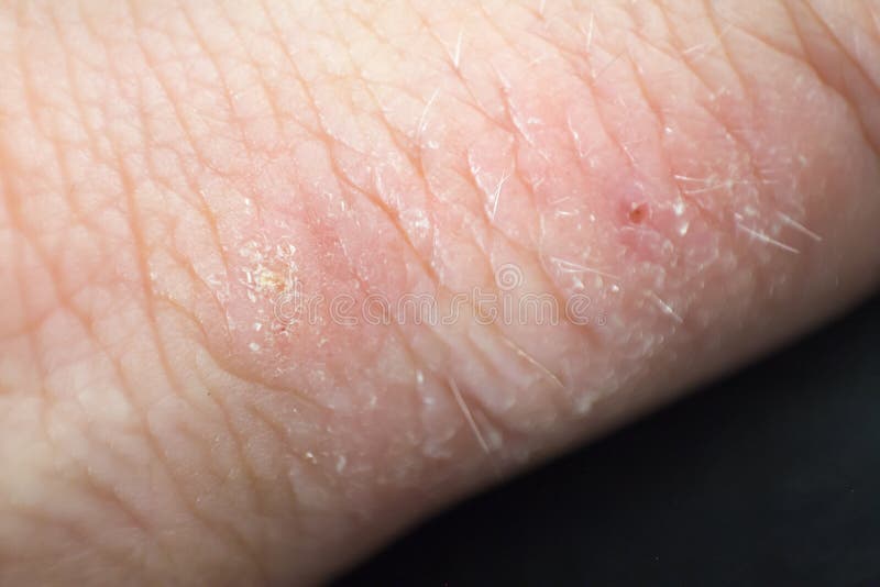 Dermatitis De La Mano Eczema De La Mano Imagen de archivo - Imagen de ...