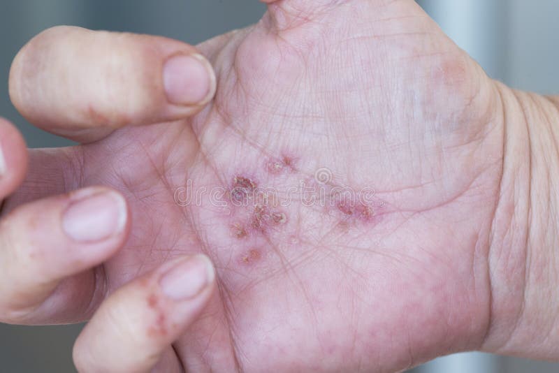 Dermatitis in hands stock image. Image of eczema, allergic - 96070181