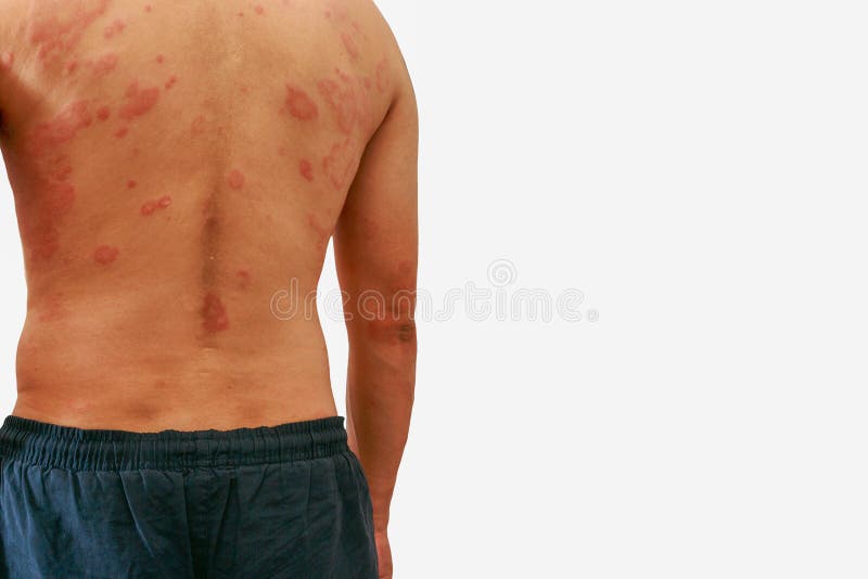 128 Atopic Dermatitis Legs Stock Photos - Free & Royalty-Free Stock ...