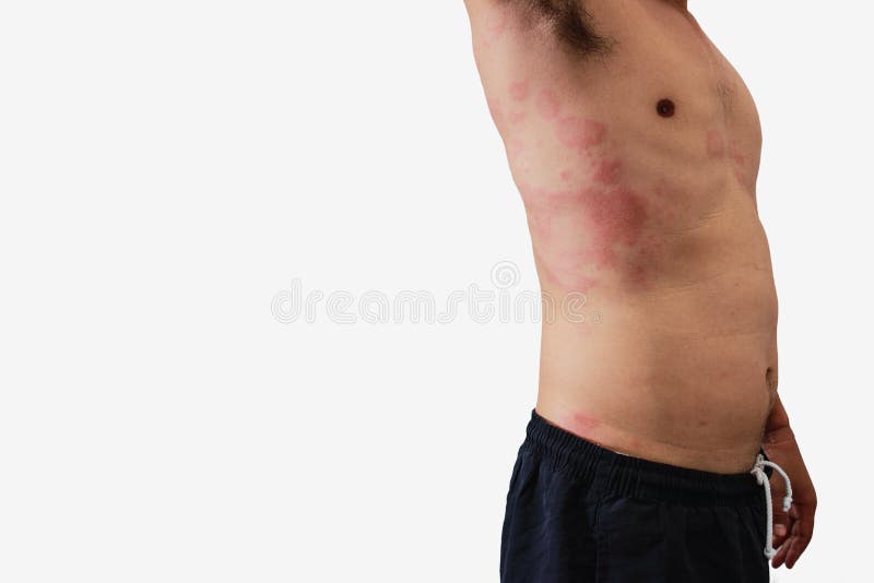 Dermatitis Problem of Rash ,Allergy Rash Stock Image - Image of sick ...
