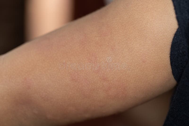 Dermatitis Small Warty Bumps Appear on the Skin in Child. Stock Photo ...