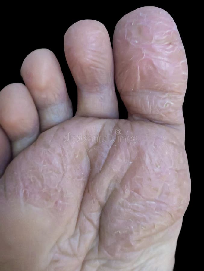 Dermatitis at the Sole of Foot Stock Image - Image of symptom, disease ...