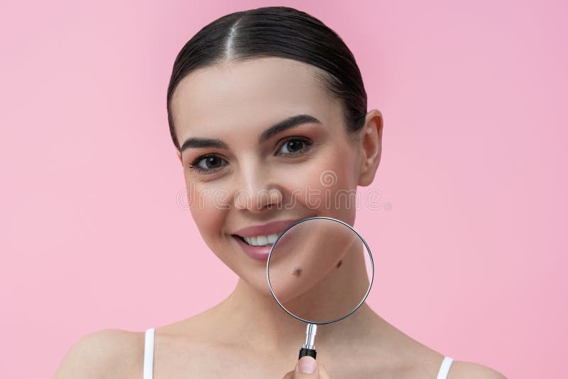 Close Up of a Woman Face with Birthmarks Stock Photo - Image of female ...