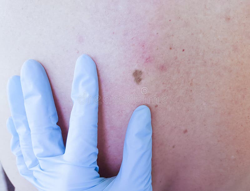 Dermatologist Examines the Patient`s Mole on the Back Stock Photo ...