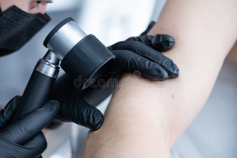 A Dermatologist Examines a Patient S Mole through a Dermatoscope. Stock ...