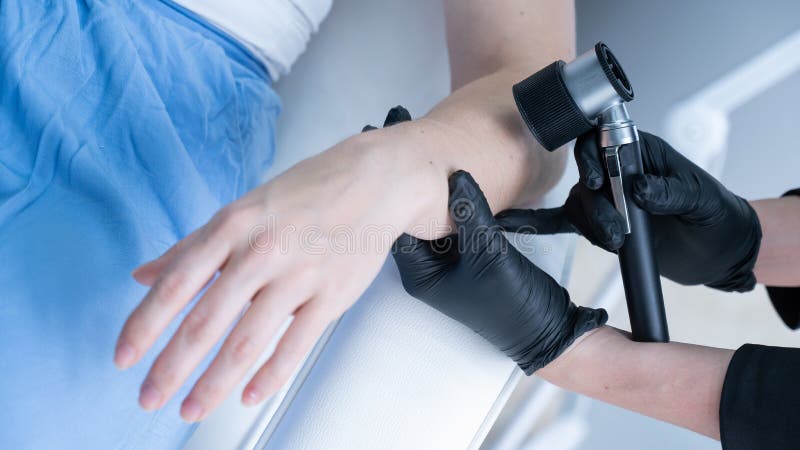 A Dermatologist Examines a Patient& X27;s Mole through a Dermatoscope ...