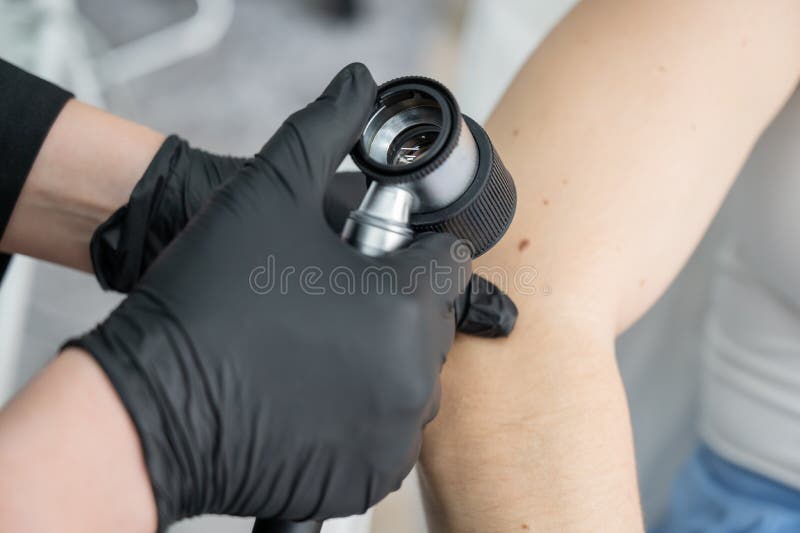 A Dermatologist Examines a Patient& X27;s Mole through a Dermatoscope ...