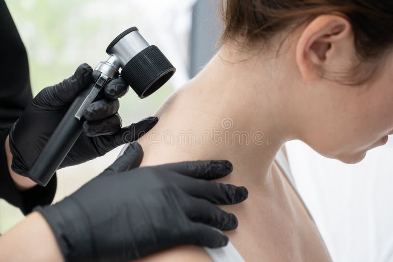 A Dermatologist Examines a Patient& X27;s Mole through a Dermatoscope ...