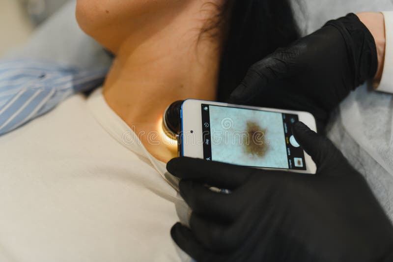 Dermatologist Examining Moles of Patient Stock Image - Image of ...