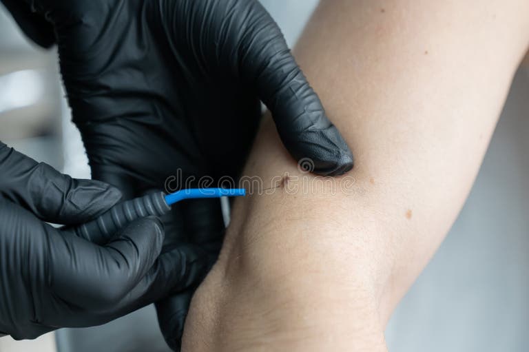 Dermatologist Removes a Mole on a Patient& X27;s Arm Using an ...