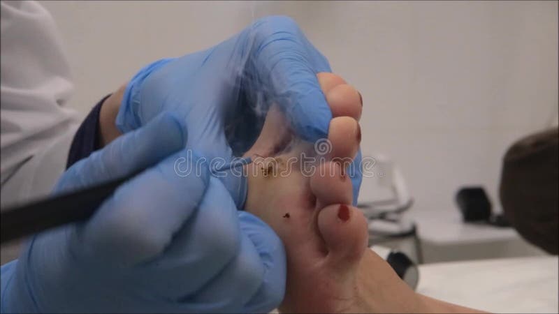 Dermatologist Surgeon Examines The Patient With The Plantar Wart Using
