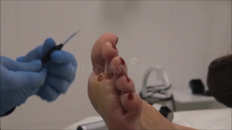 Dermatologist Surgeon Performs Wart Removal With Electrocoagulator