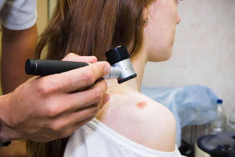 Dermatoscopy editorial stock photo. Image of nevus, dermatology - 60265588