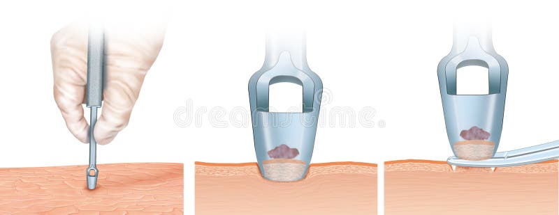 Insertion tool skin stock illustration. Illustration of parasites ...