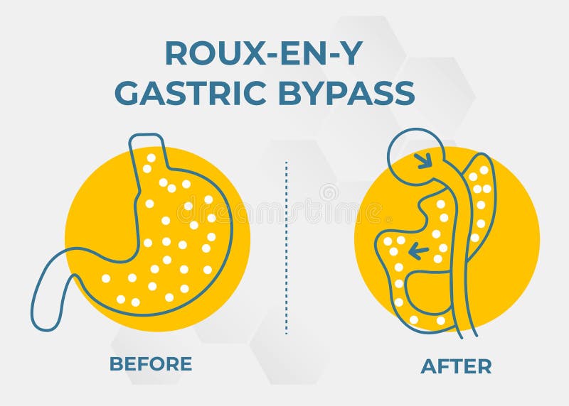 Roux-en-Y Gastric Bypass (RNY) Weight Loss Surgery Vector Illustration ...