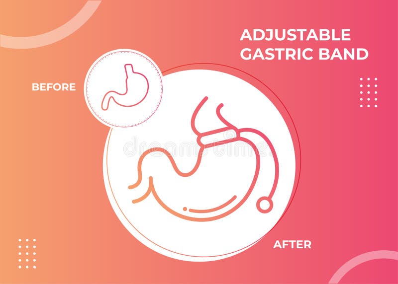 Illustration of Adjustable Gastric Band Devise Weight Loss Surgery ...
