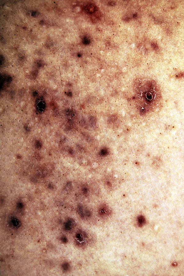 Espinillas en piel imagen de archivo. Imagen de picadura - 6823791