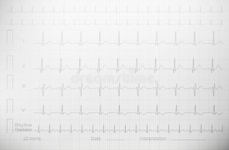 Dessin D'ECG Sur Le Papier Carré Illustration Stock - Illustration of ...