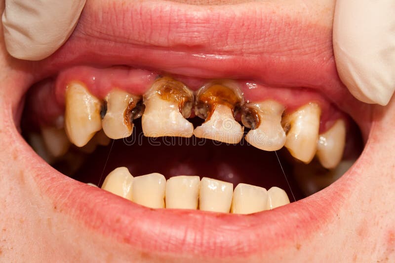 Caries teeth decay stock image. Image of medicine, medical - 22629057