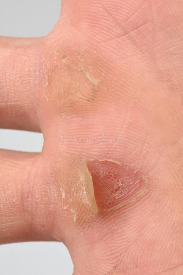 Detail of calluses stock image. Image of closeup, palm - 79502823