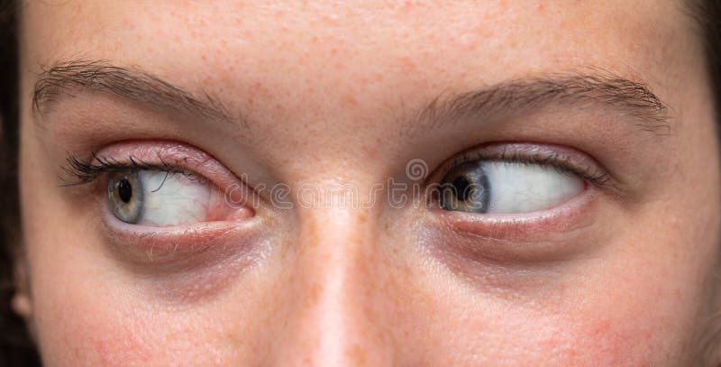 Detail of Puzzled Facial Expression with Perplexed Sideways Glance ...